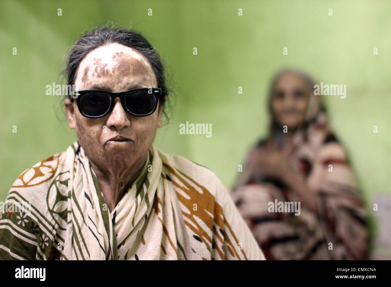Pakistan acid attack victim hi-res stock photography and images - Alamy