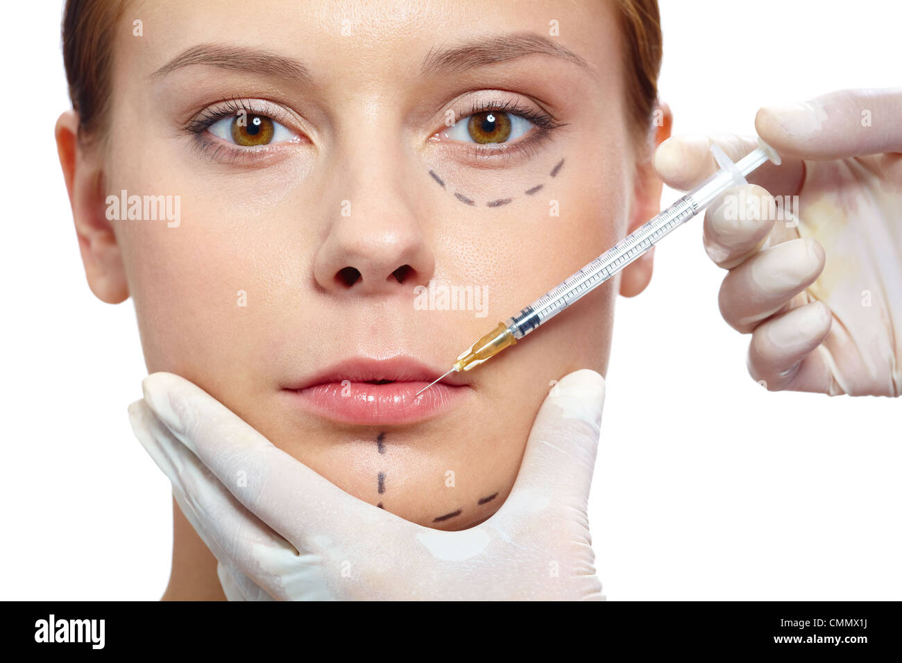 Fresh woman with marks drawn on face during botox procedure Stock Photo ...