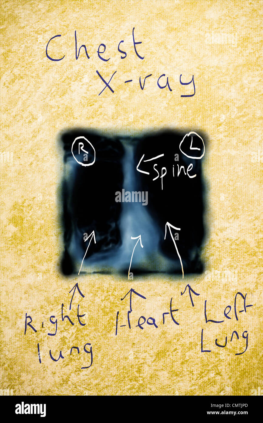 Annotated picture of a chest x-ray on a grungy piece of parchment Stock ...