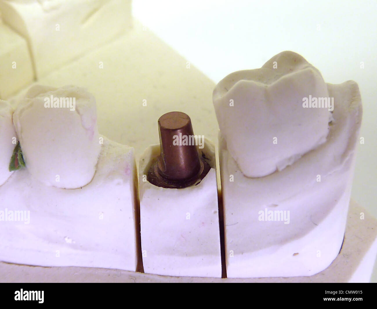 Metallic implant abutment on white plaster teeth model for dental ...