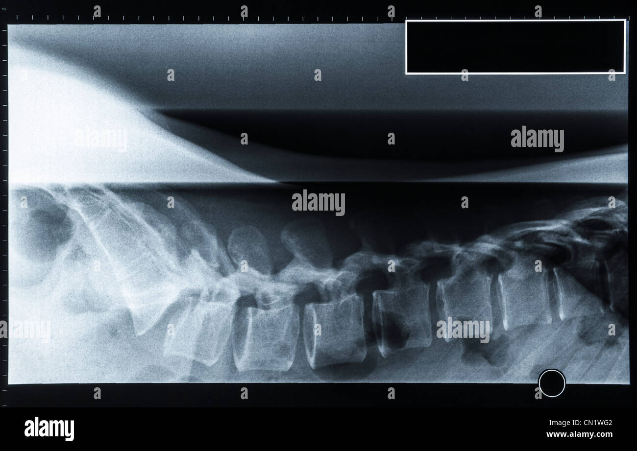 X-Ray image of human spinal column Stock Photo - Alamy