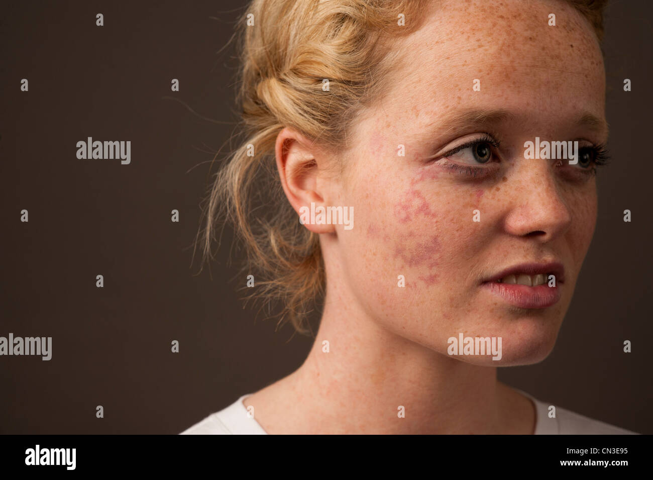 A young woman girl with a 'port wine' birthmark on the right side of ...