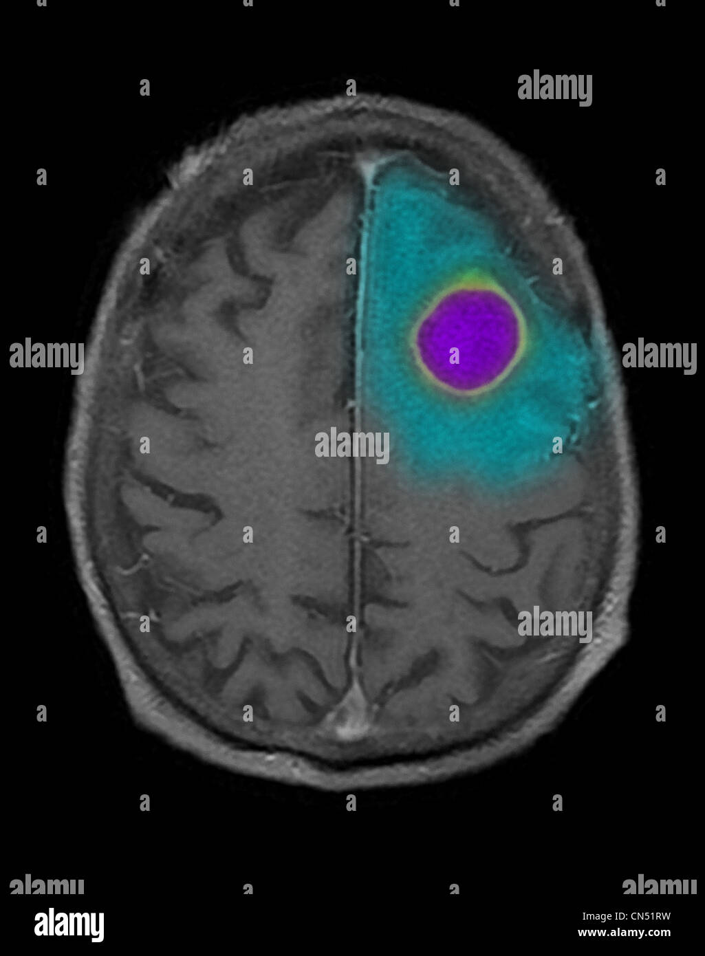 MRI scan slice through the brain of an 87 year old man, showing an ...