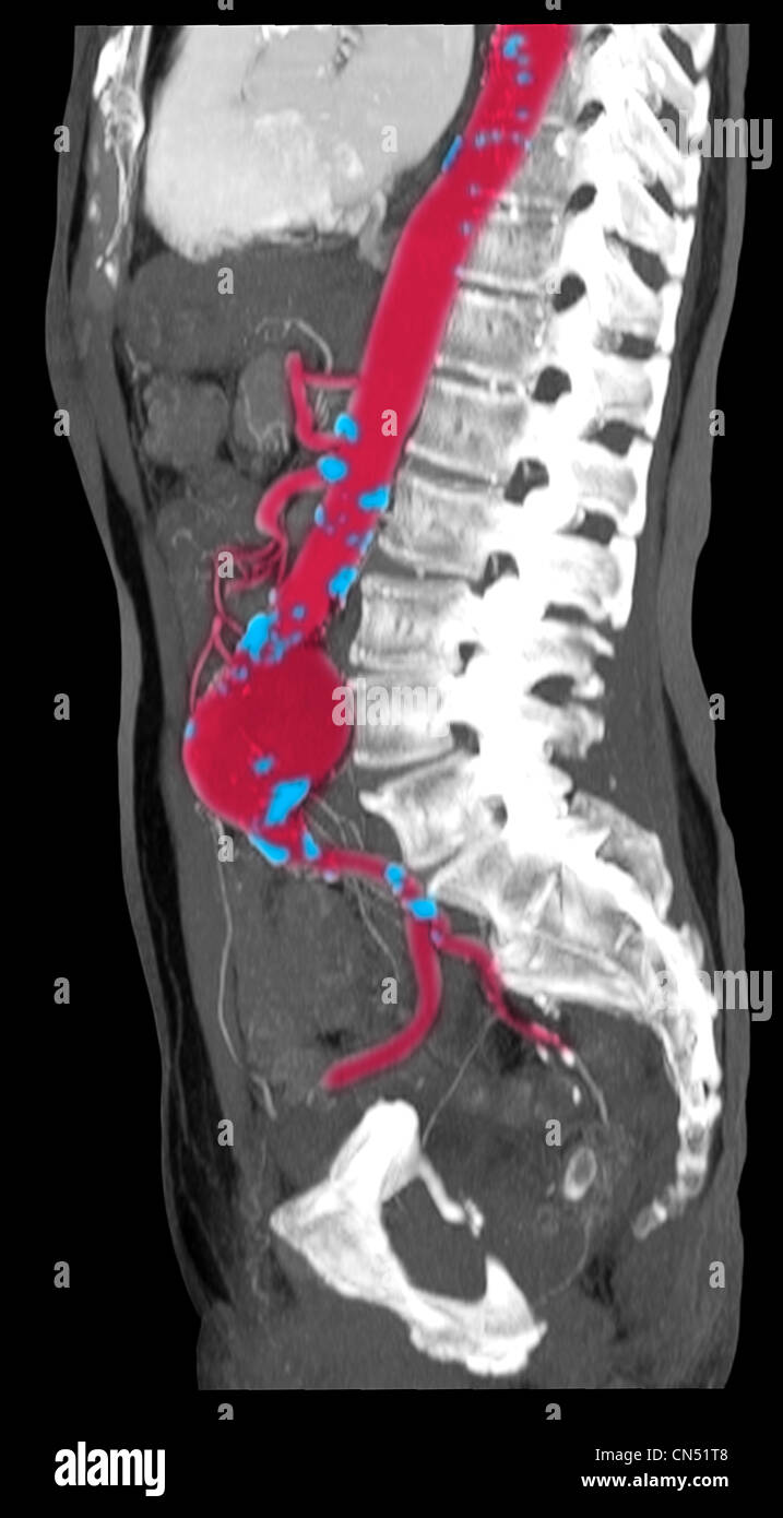 CT scan images showing an abdominal aortic aneurysm Stock Photo - Alamy