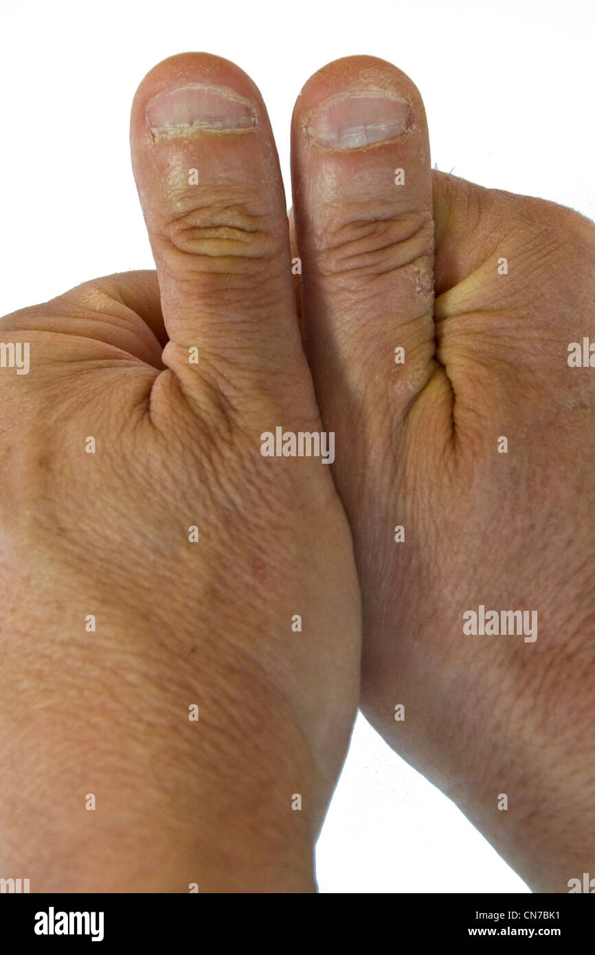 Bitten nails hi-res stock photography and images - Alamy