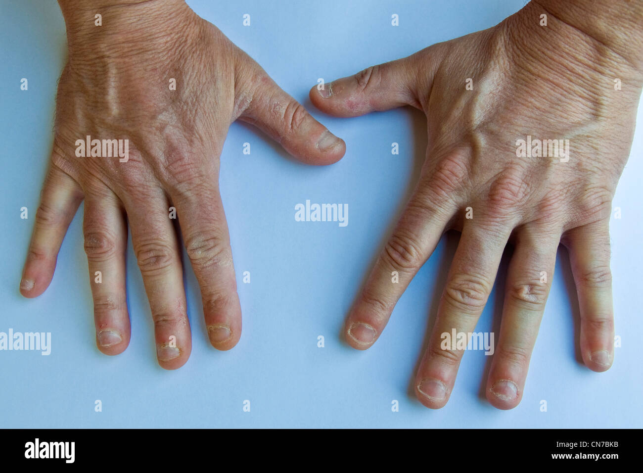 Bitten nails hi-res stock photography and images - Alamy