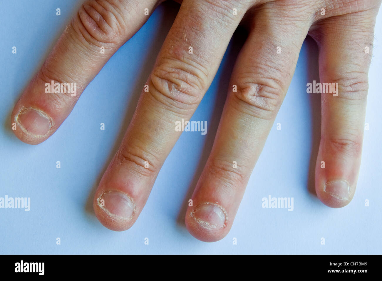 Hand with bitten nails Stock Photo - Alamy