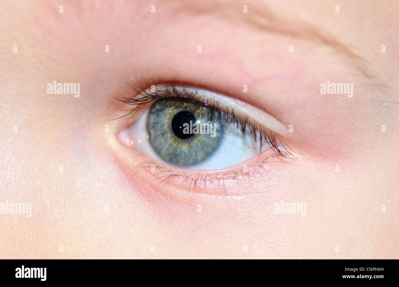 Phlebitis hi-res stock photography and images - Alamy