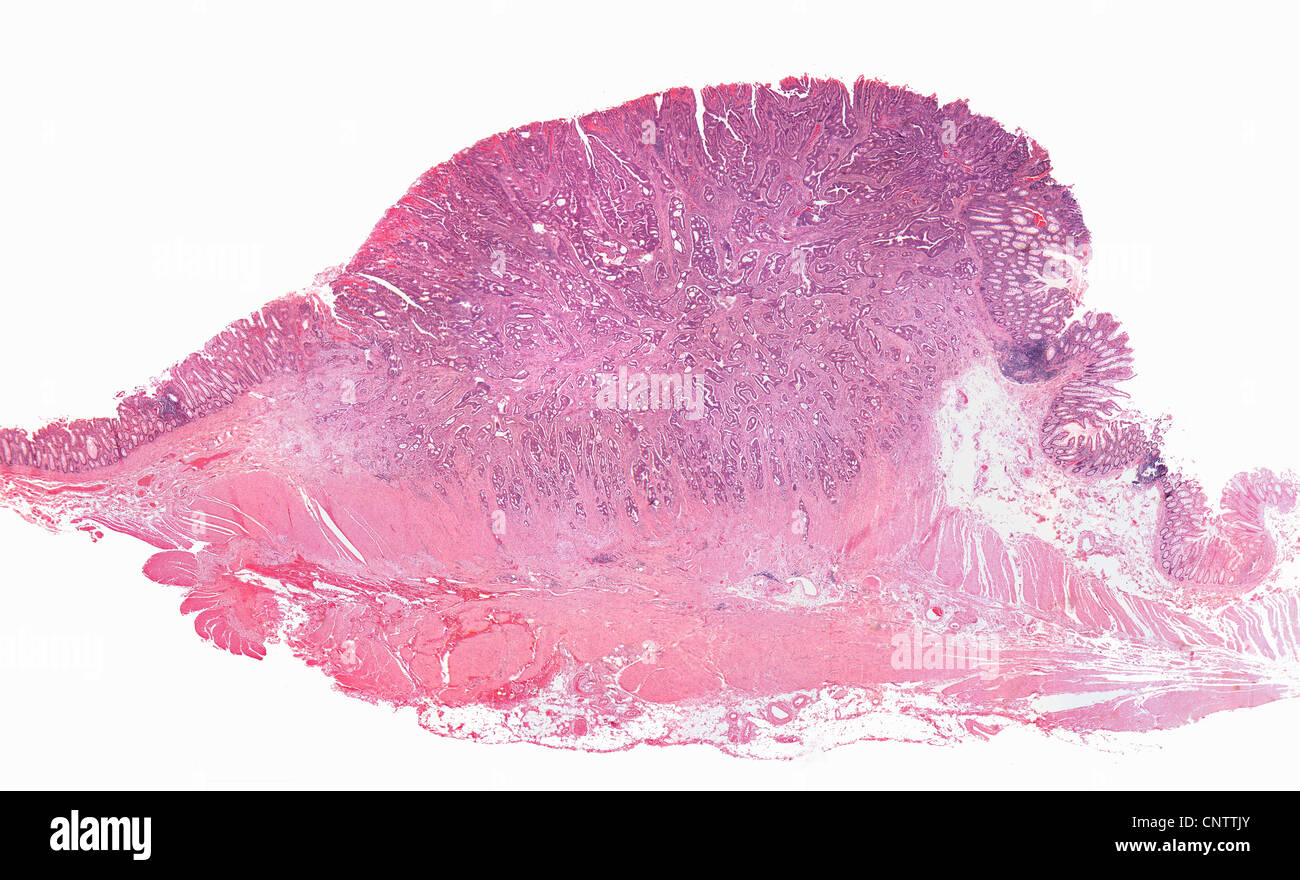 Close up of invasive colon cancer cells Stock Photo - Alamy