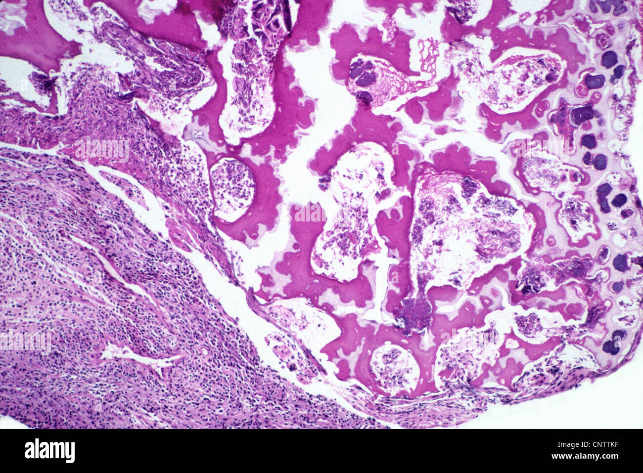 Infected cells of bone plate Stock Photo - Alamy