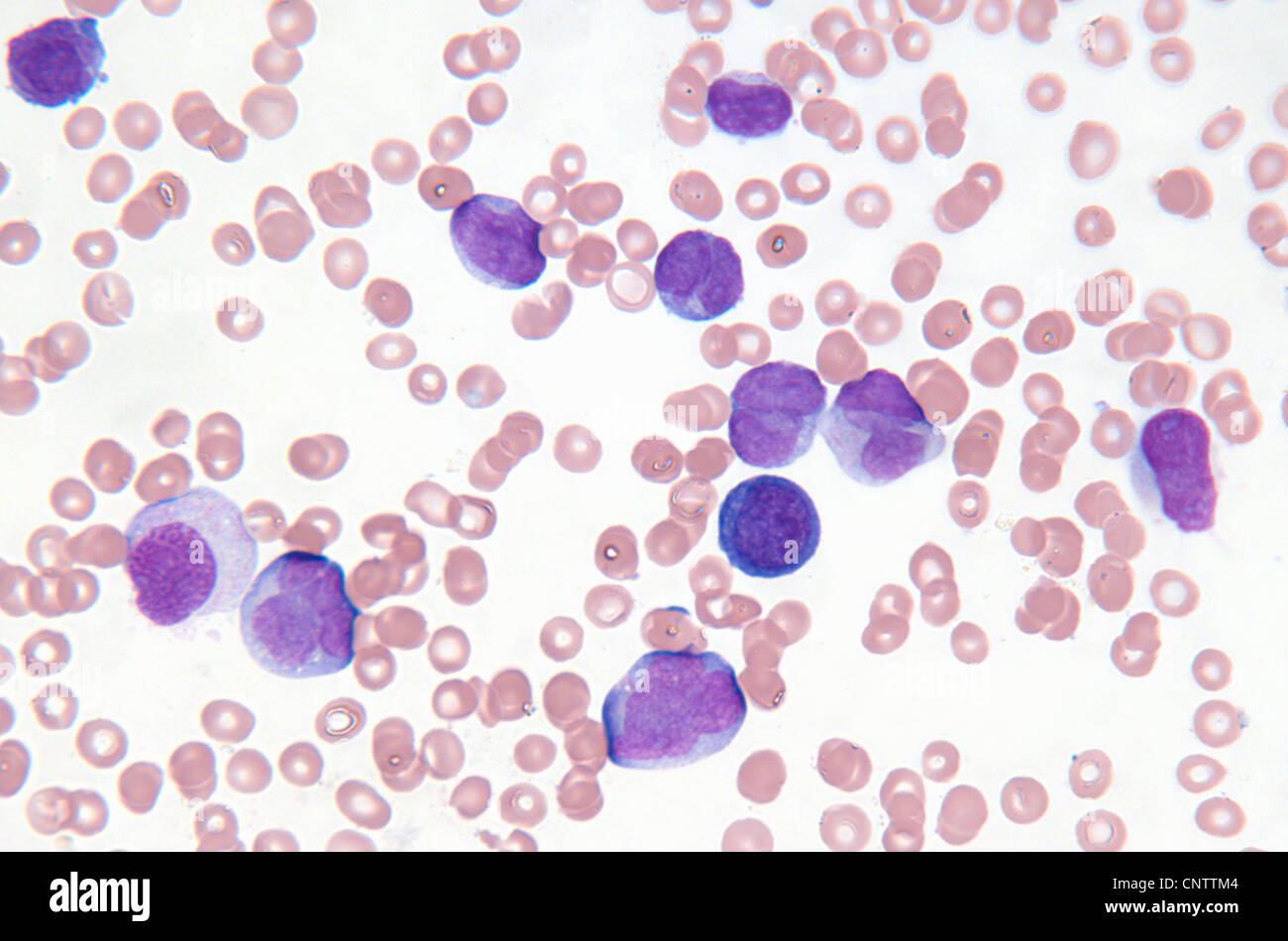 Acute leukemia hi-res stock photography and images - Alamy