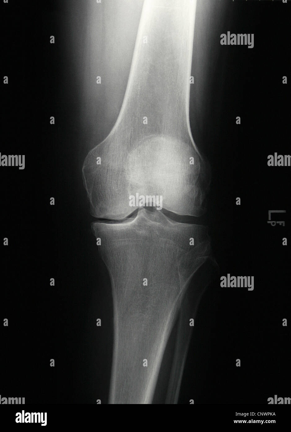 Radiograph of the elbow joint hi-res stock photography and images - Alamy