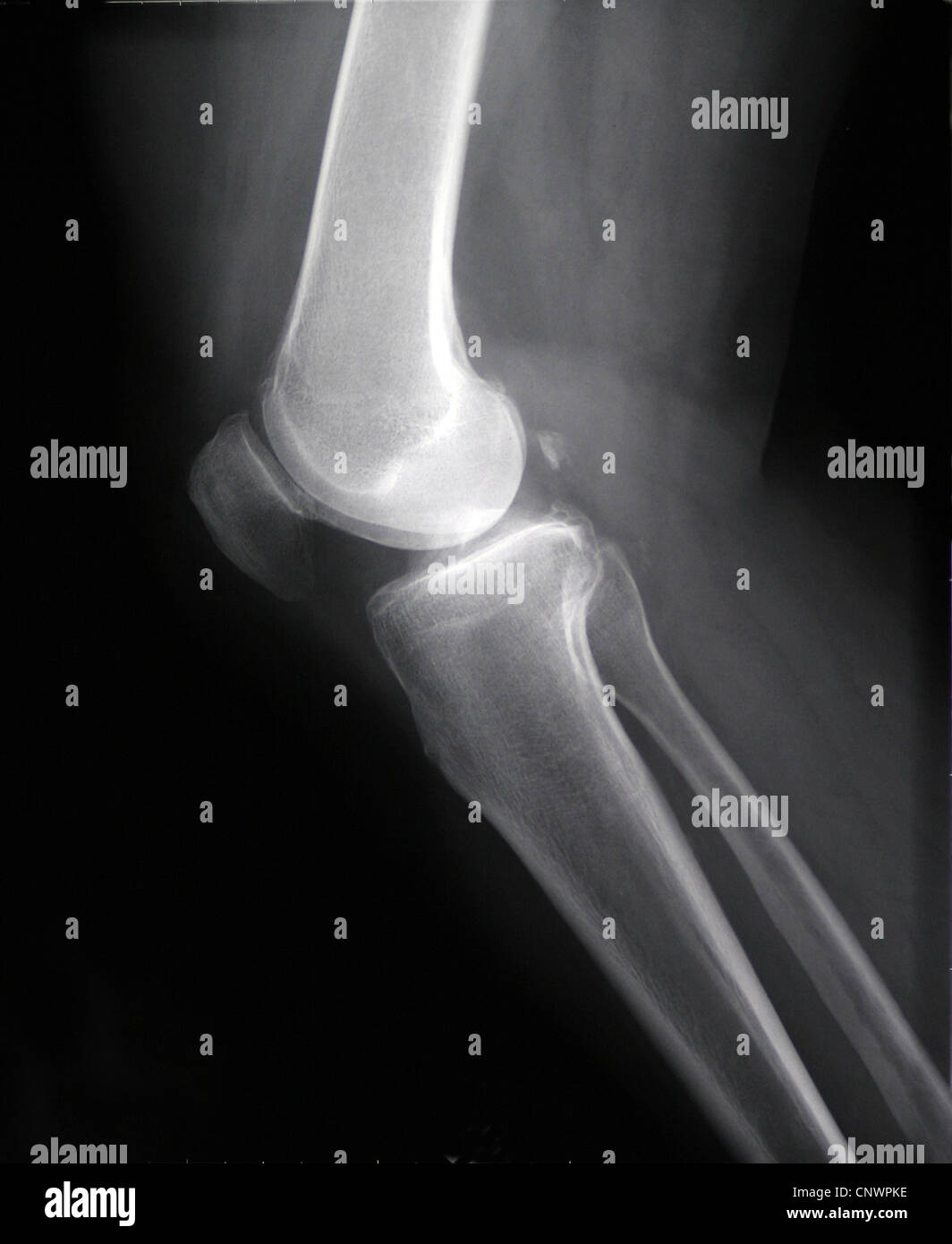 fluoroscopic image of joint knee Stock Photo - Alamy