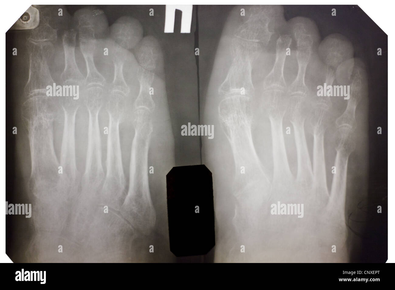 X ray nail injury to foot hi-res stock photography and images - Alamy