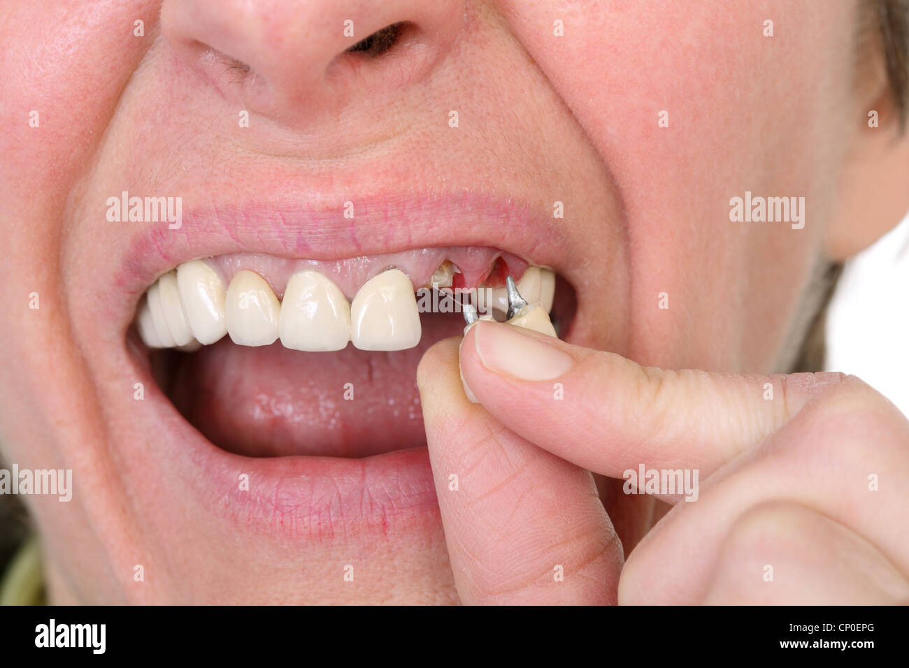 Open denture hi-res stock photography and images - Alamy