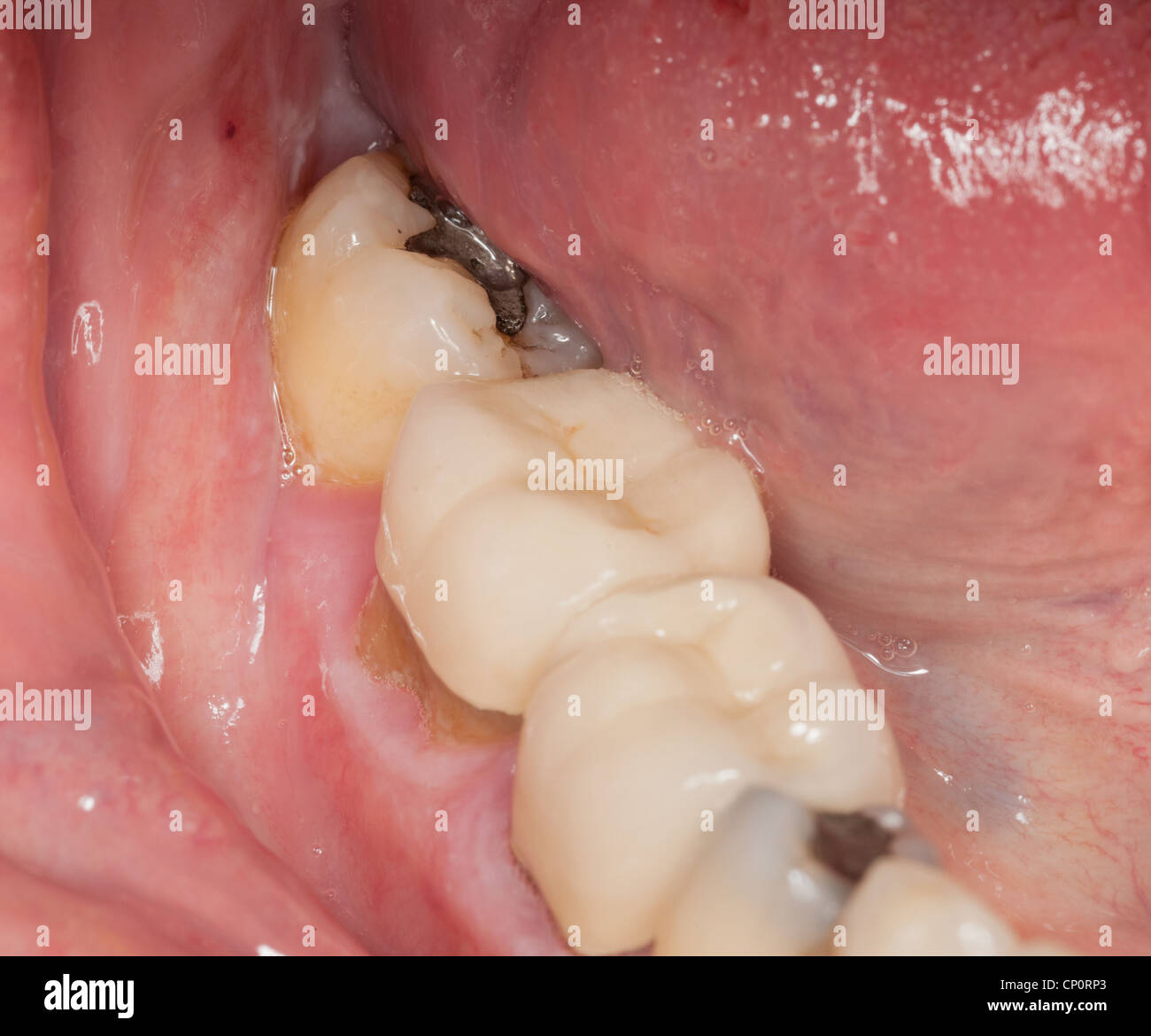 Amalgam fillings hi-res stock photography and images - Alamy