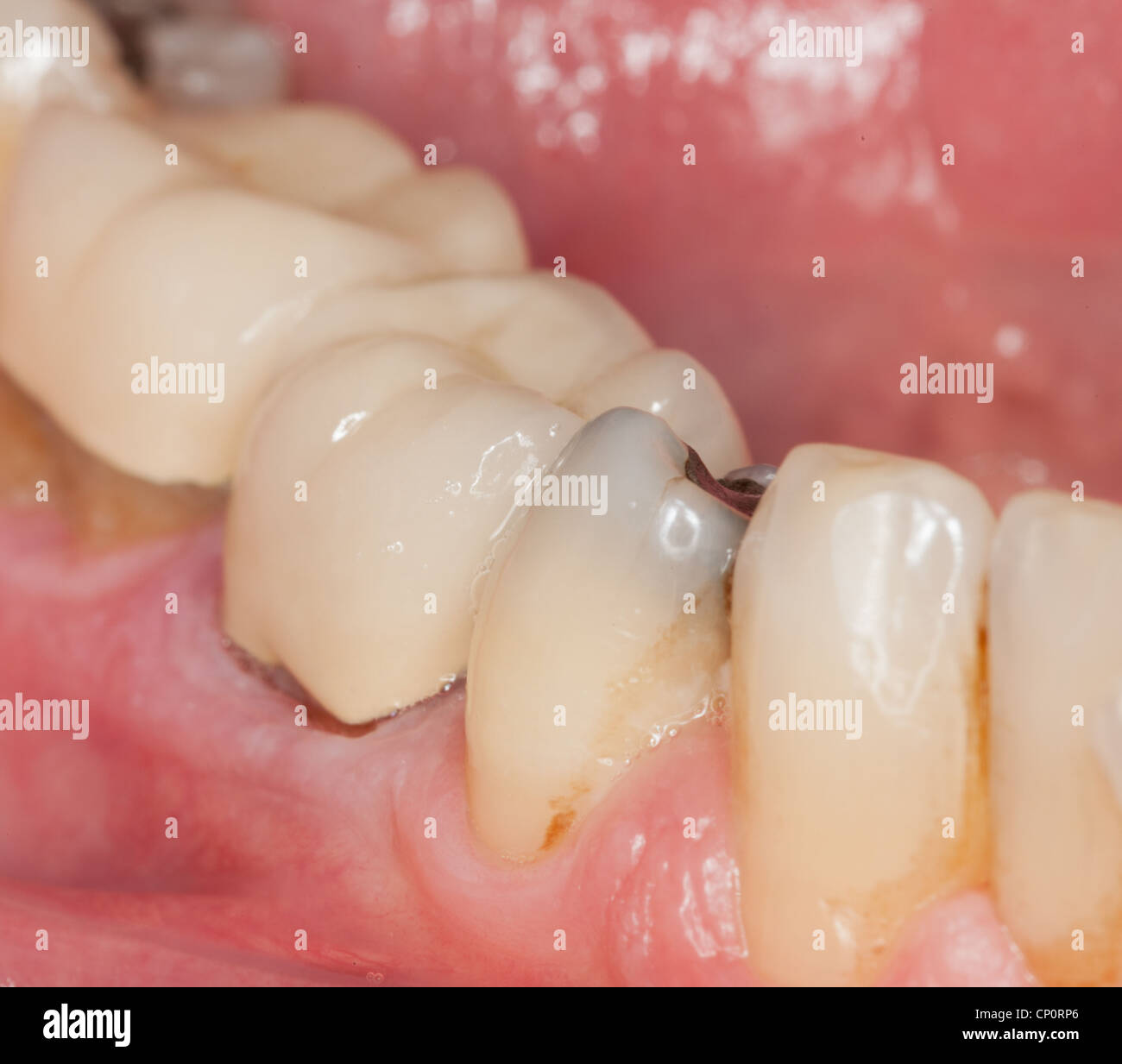 Gold filling teeth hi-res stock photography and images - Alamy
