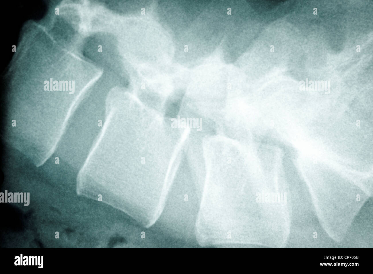 Human spine xray hi-res stock photography and images - Alamy