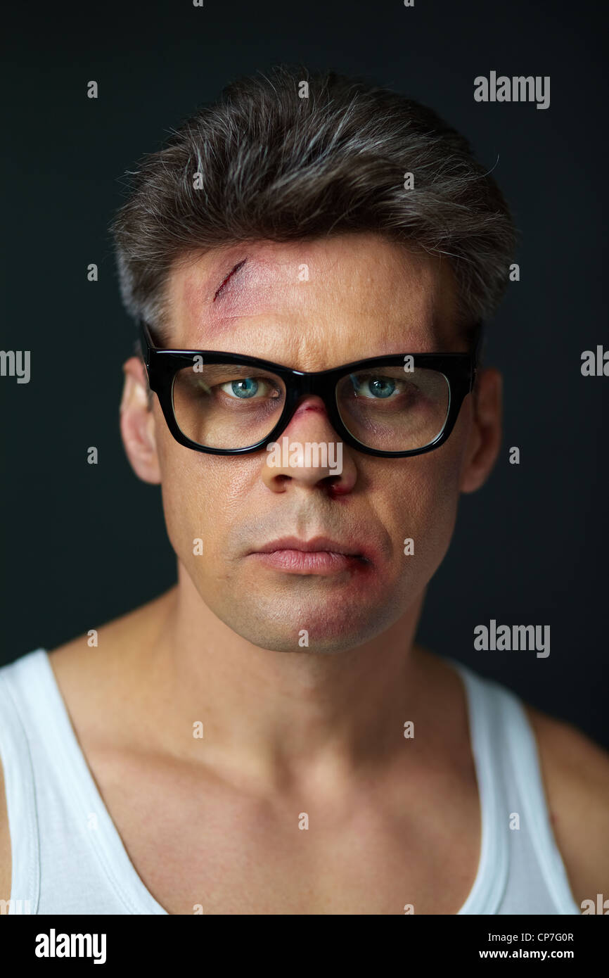 Bruised face hi-res stock photography and images - Alamy