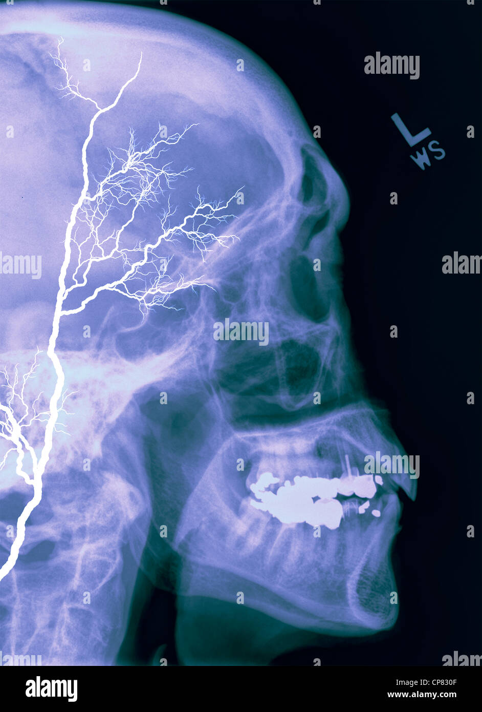 X-ray human skull with lightning bolt Stock Photo - Alamy
