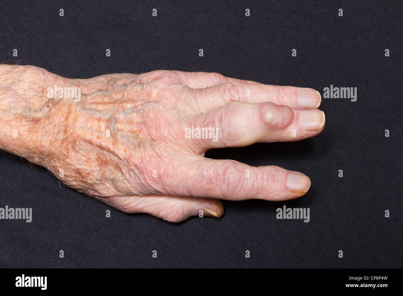 Ganglion Cyst On Finger Stock Photo Image Of Cyst Carpal Ganglion Cyst