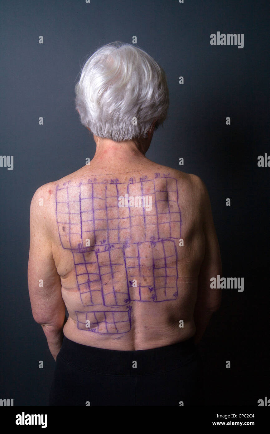A woman patient's back is drawn with squares indicating locations for ...
