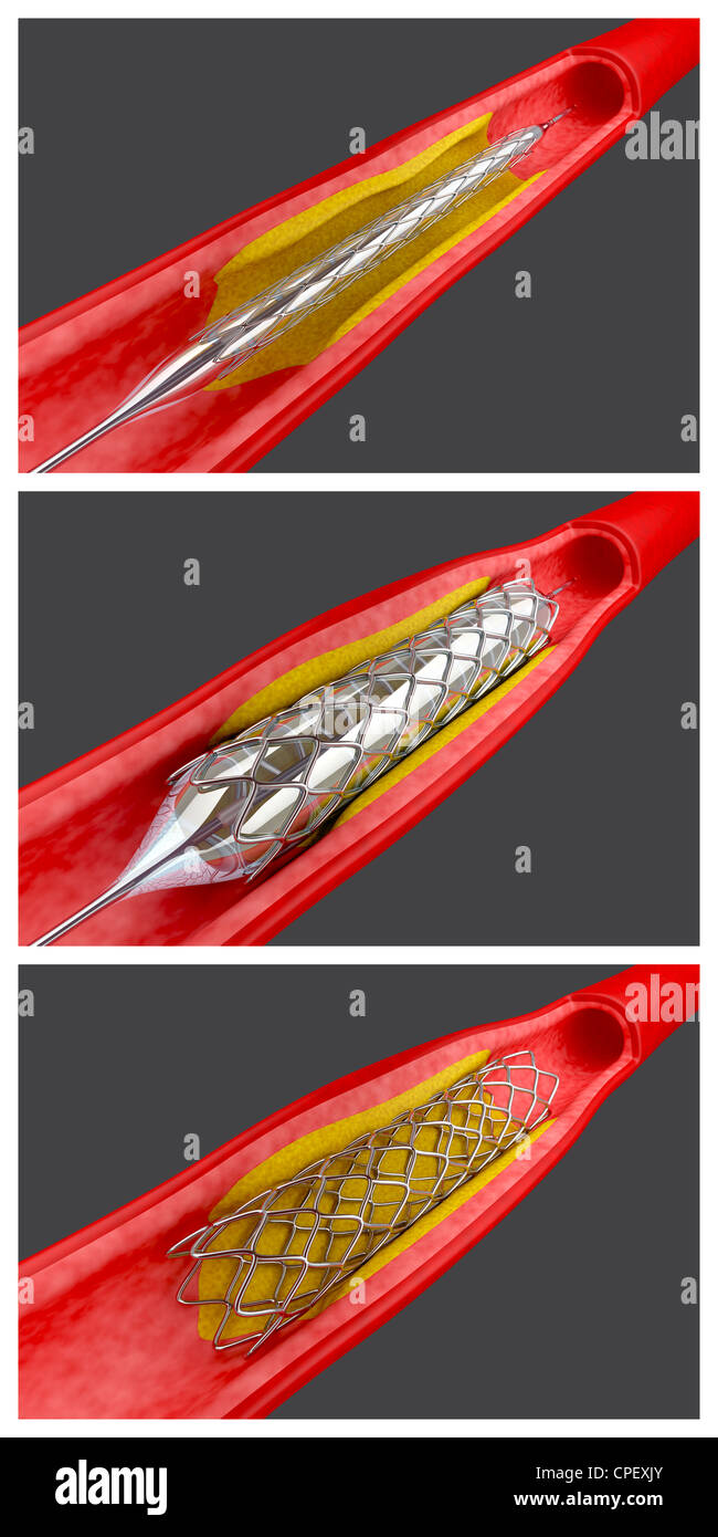 Is Balloon Angioplasty A Stent at Nate Hocking blog