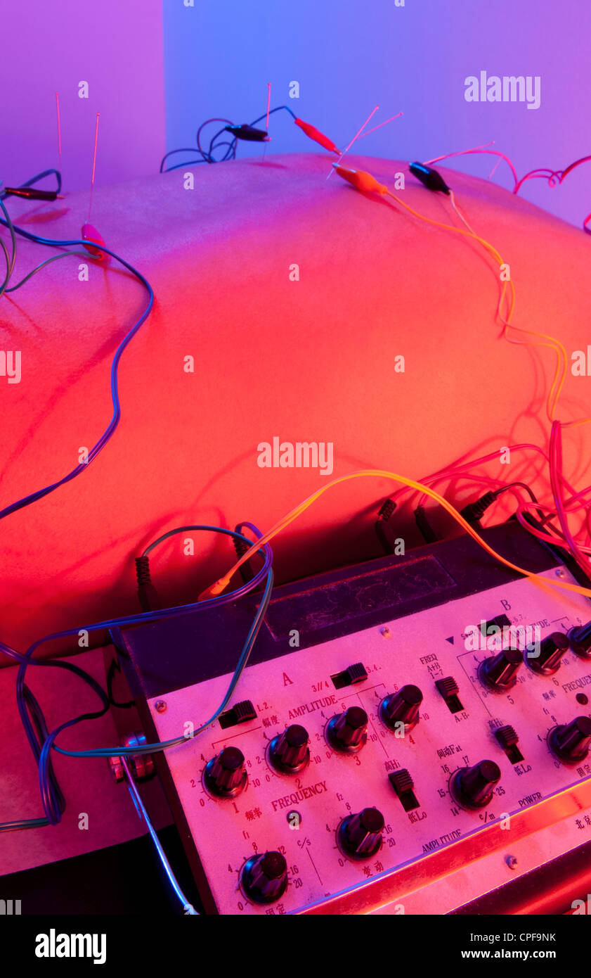 Man patient getting electronic stimulation from Acupunctoscope needles ...