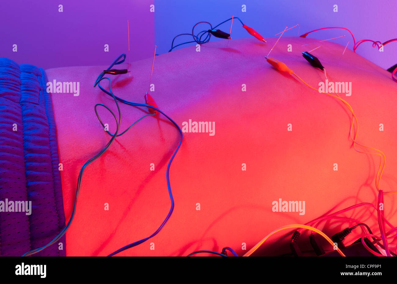 Man patient getting electronic stimulation from Acupunctoscope needles ...