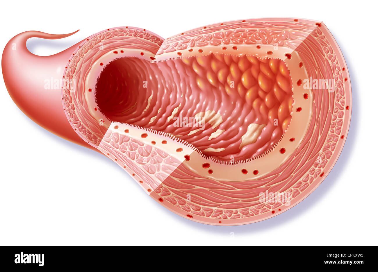 CROHN'S DISEASE, DRAWING Stock Photo - Alamy