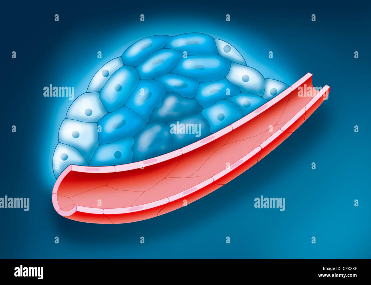 Tumor High Resolution Stock Photography and Images - Alamy