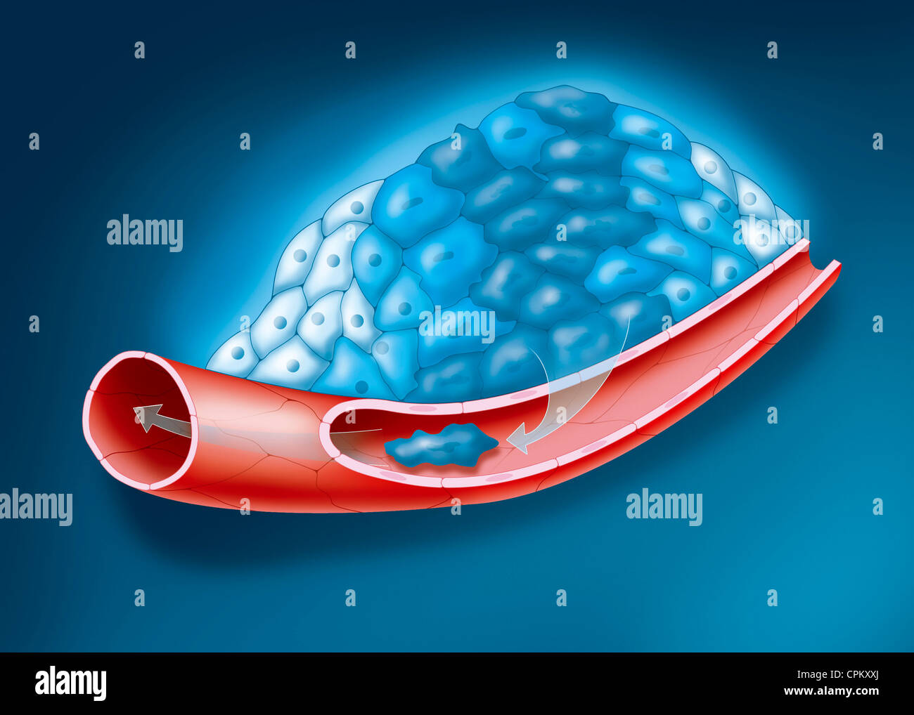 Tumor vascularization hi-res stock photography and images - Alamy