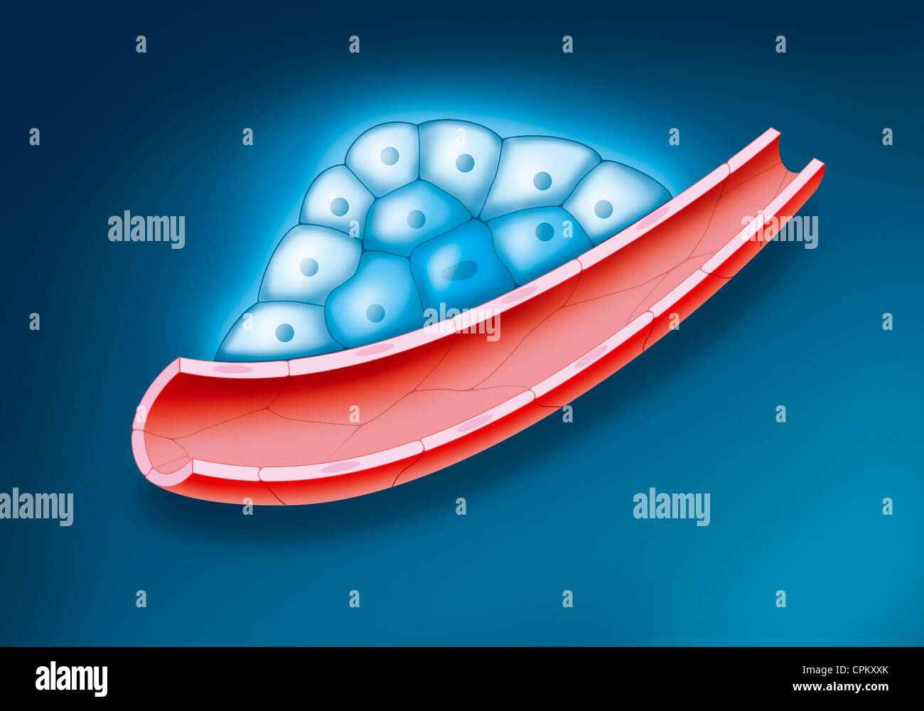 TUMOR DRAWING Stock Photo Alamy tumor-drawing-stock-photo-alamy