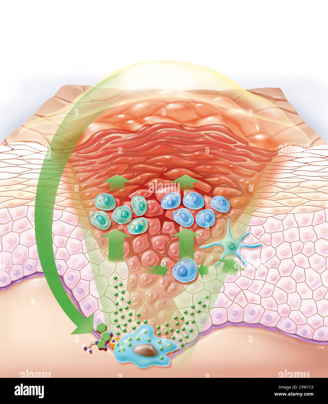 Keratosis hi-res stock photography and images - Alamy