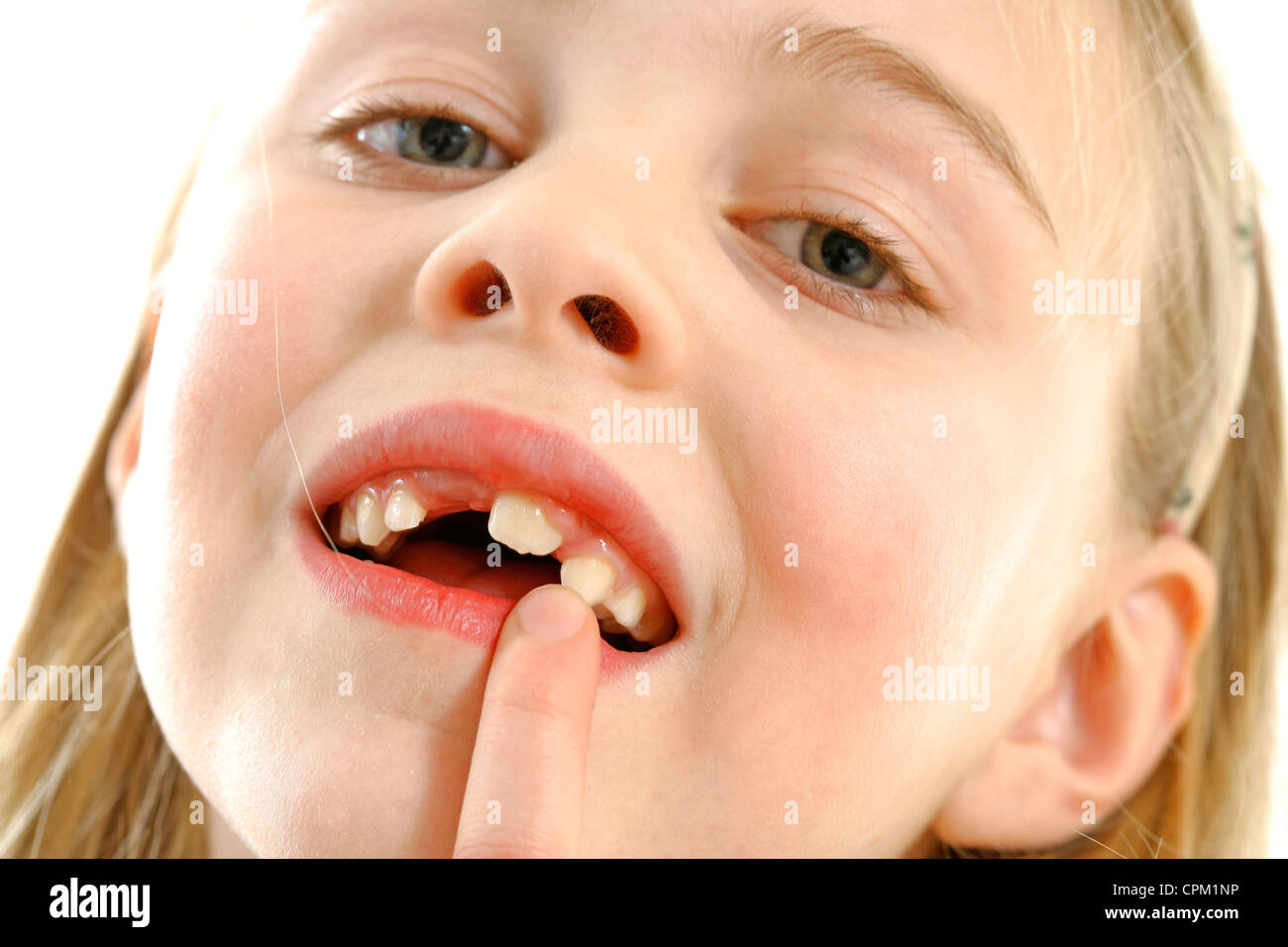 Milk Tooth Stock Photos & Milk Tooth Stock Images - Alamy