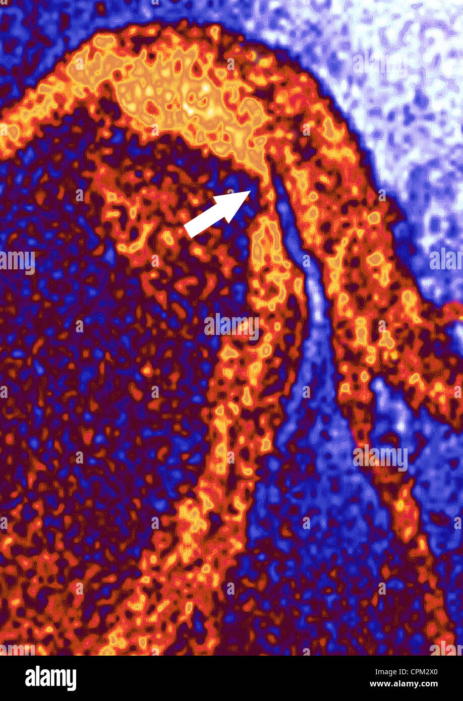 MYOCARDIAL INFARCTION, ANGIOGRA Stock Photo - Alamy