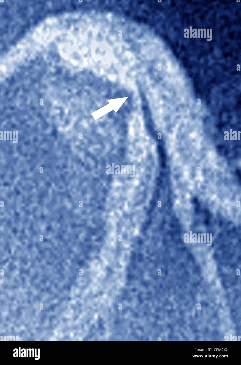 MYOCARDIAL INFARCTION, ANGIOGRA Stock Photo - Alamy