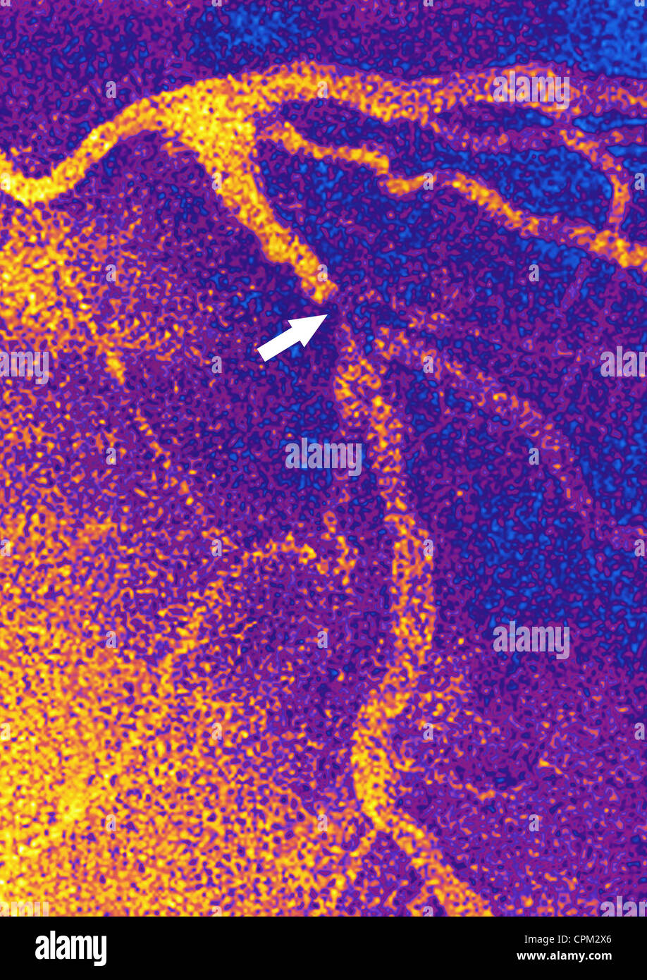 MYOCARDIAL INFARCTION, ANGIOGRA Stock Photo - Alamy