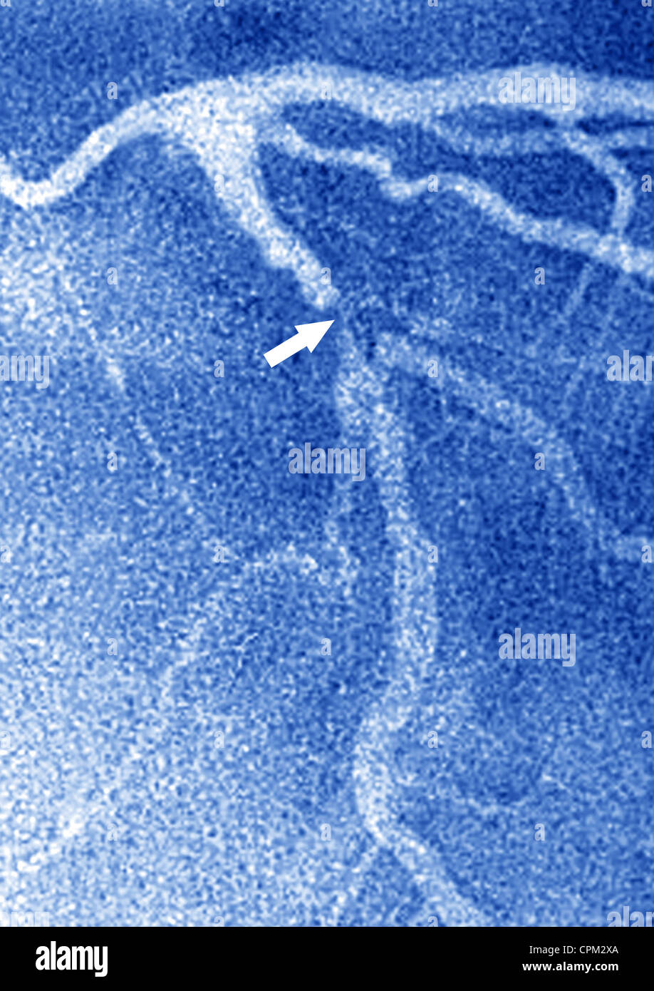 MYOCARDIAL INFARCTION, ANGIOGRA Stock Photo - Alamy