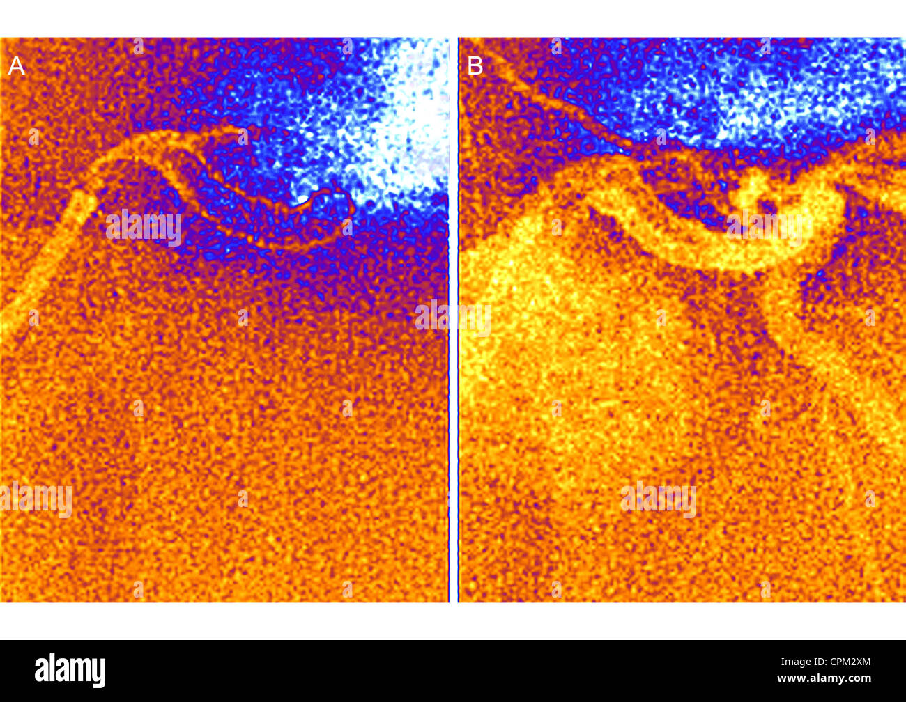ARTERIAL ANGIOPLASTY, RESULT Stock Photo - Alamy ARTERIAL ANGIOPLASTY, RESULT Stock Photo - Alamy
