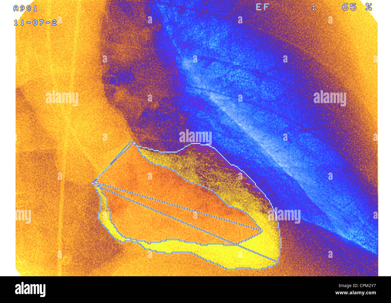 Human heart attack hi-res stock photography and images - Alamy
