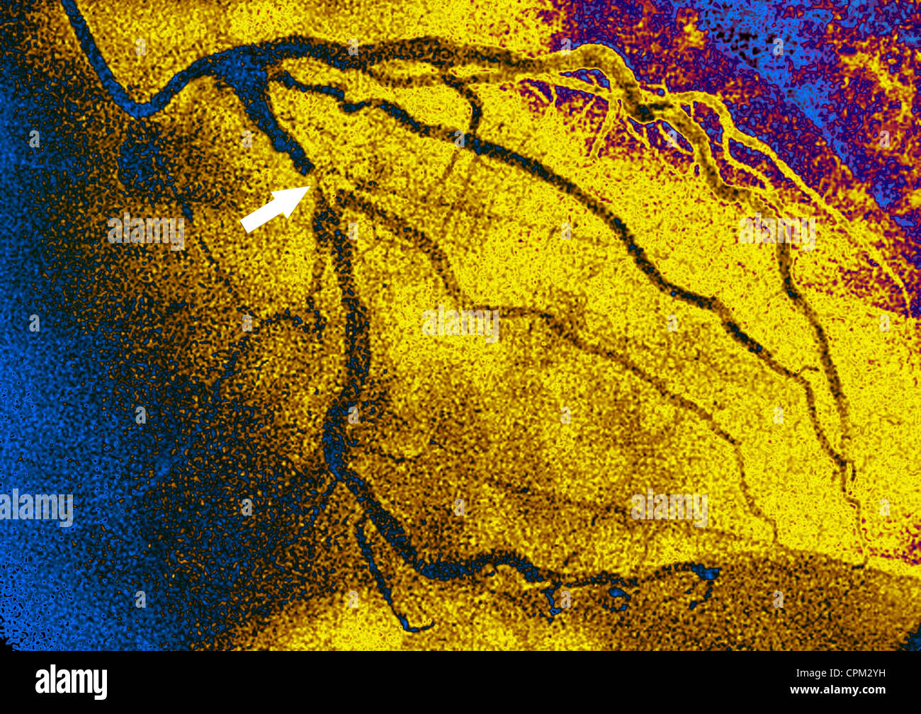 MYOCARDIAL INFARCTION, ANGIOGRA Stock Photo - Alamy