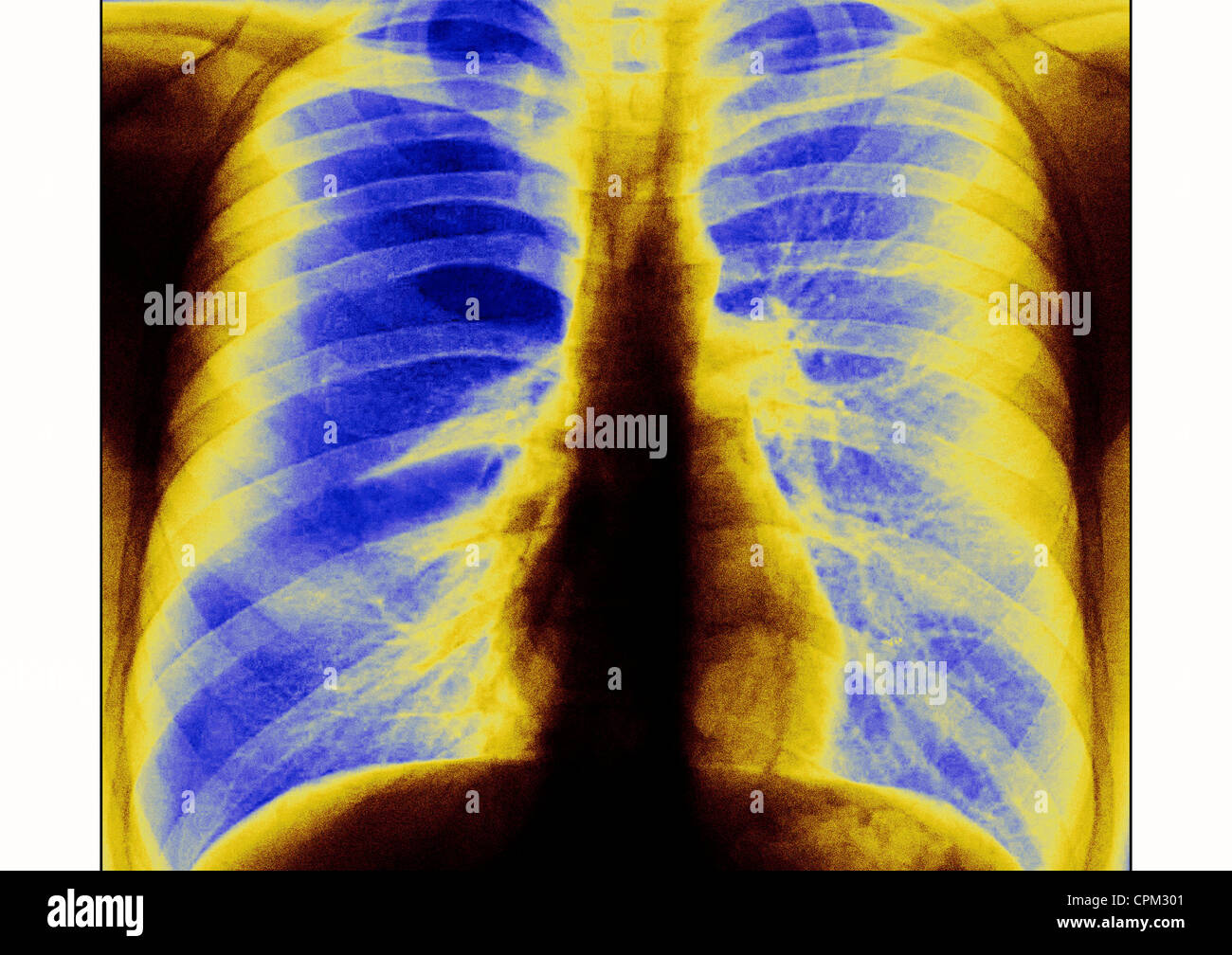 Asthma X Ray Stock Photos & Asthma X Ray Stock Images - Alamy