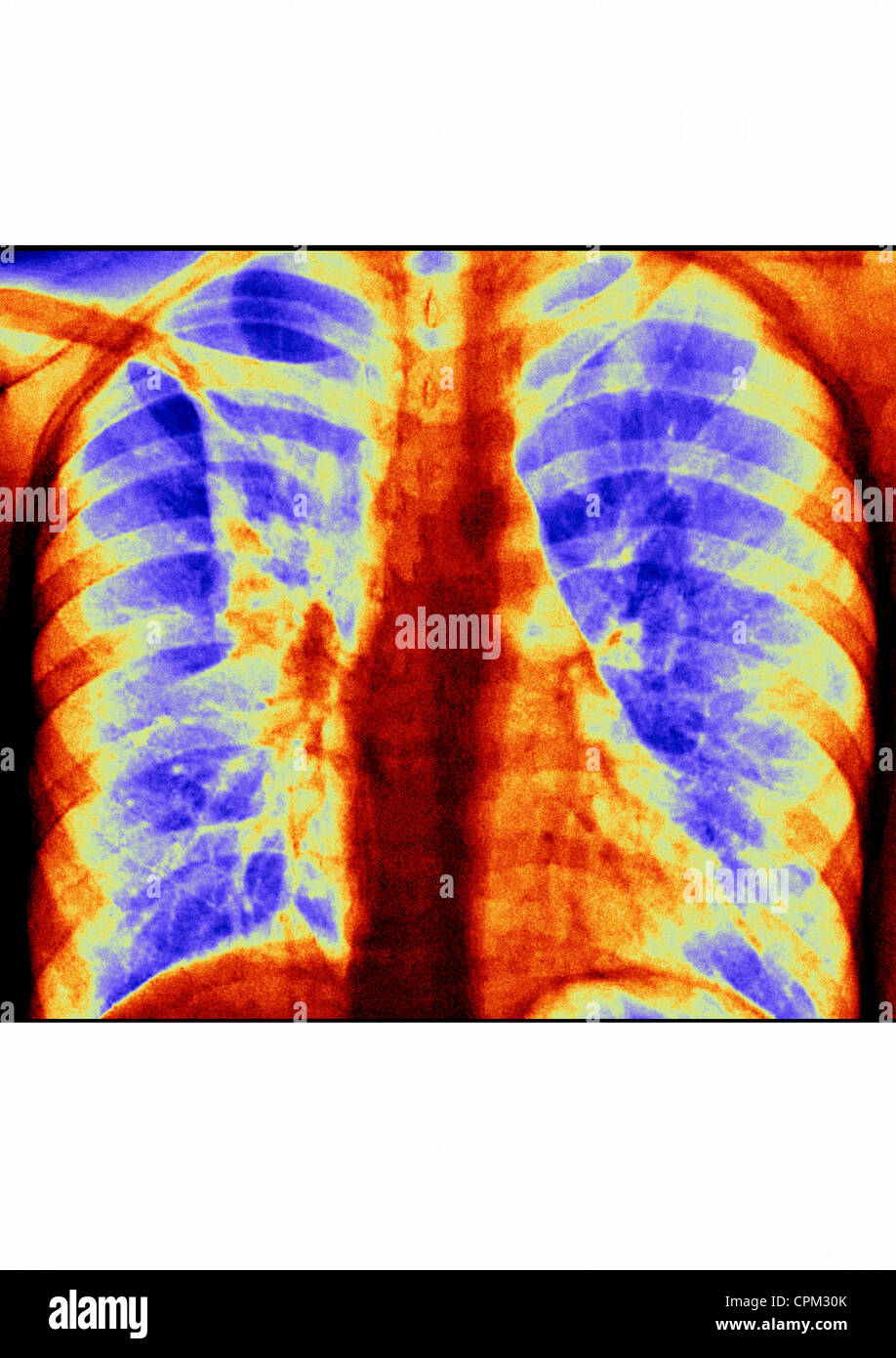 X ray lungs hi-res stock photography and images - Alamy