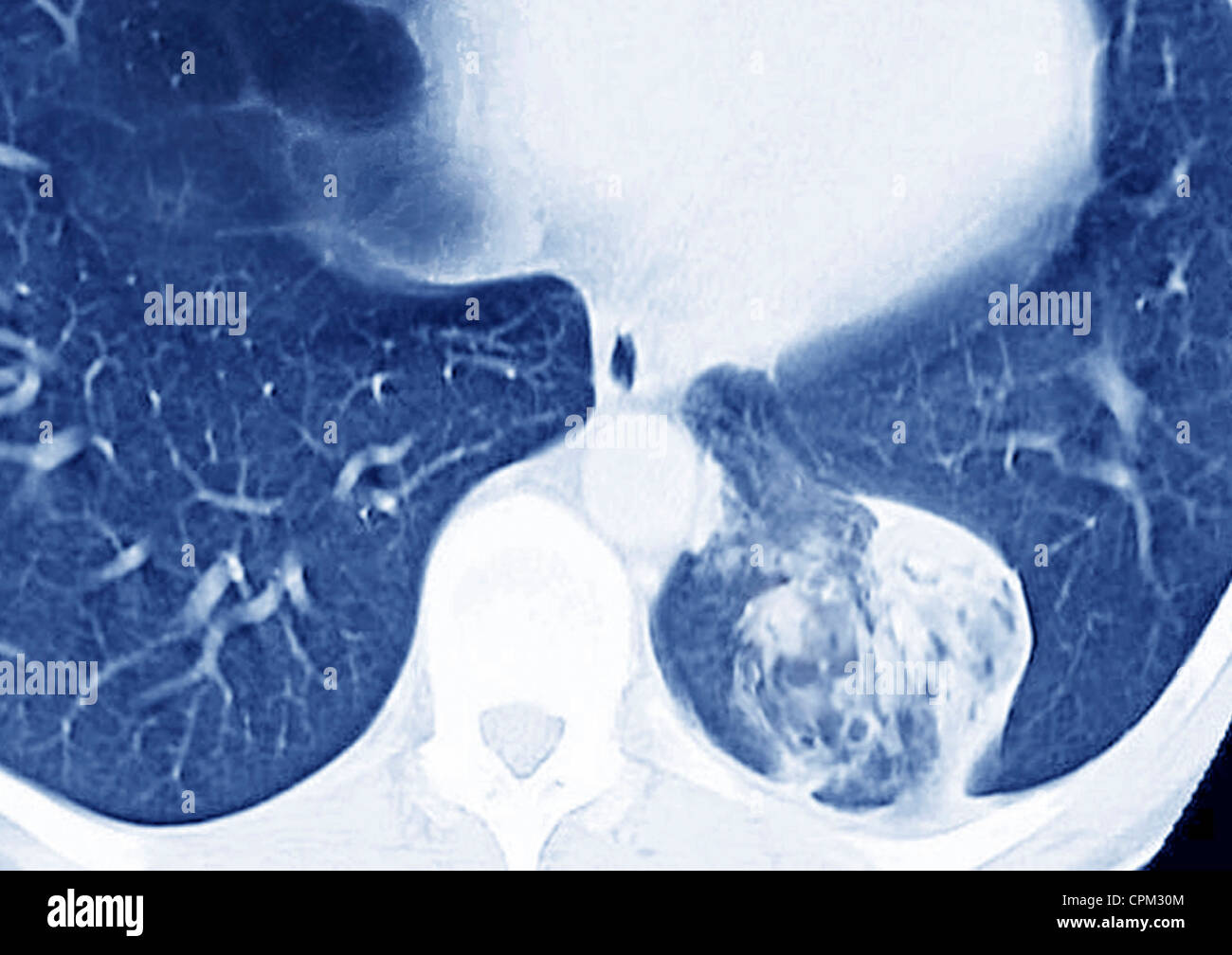LUNG CANCER, SCAN Stock Photo - Alamy