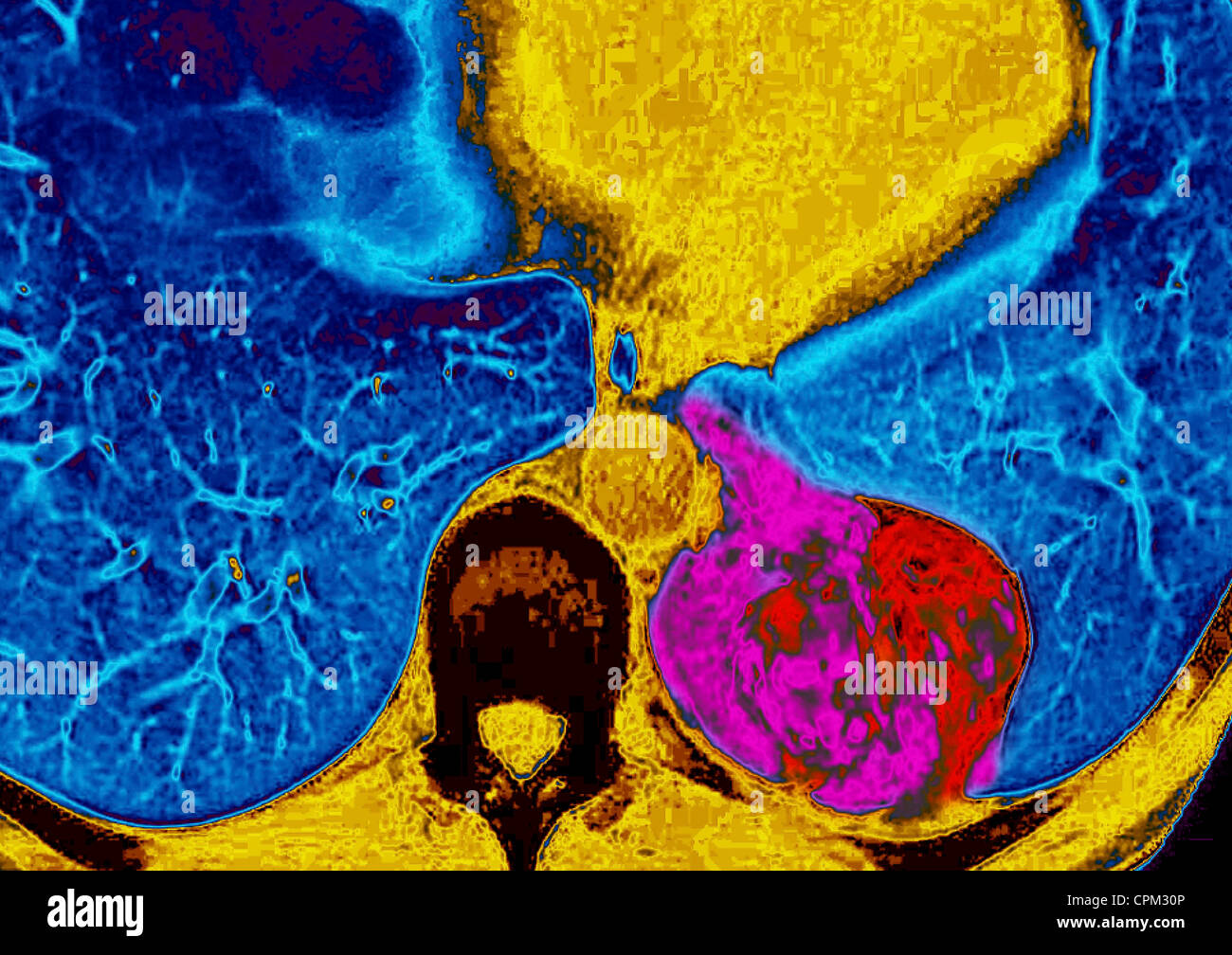 LUNG CANCER, SCAN Stock Photo - Alamy