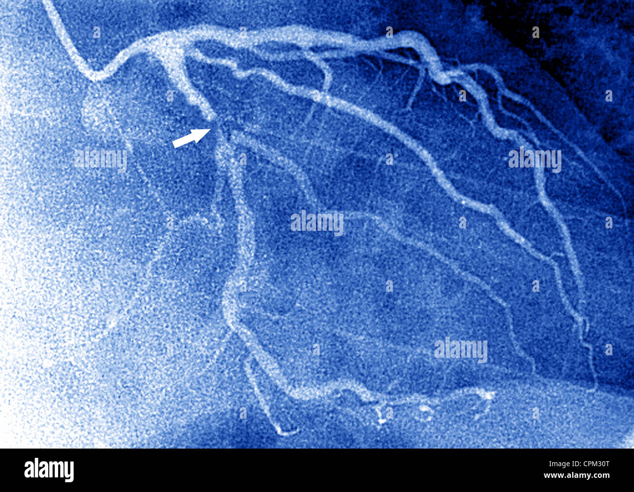 MYOCARDIAL INFARCTION, ANGIOGRA Stock Photo - Alamy