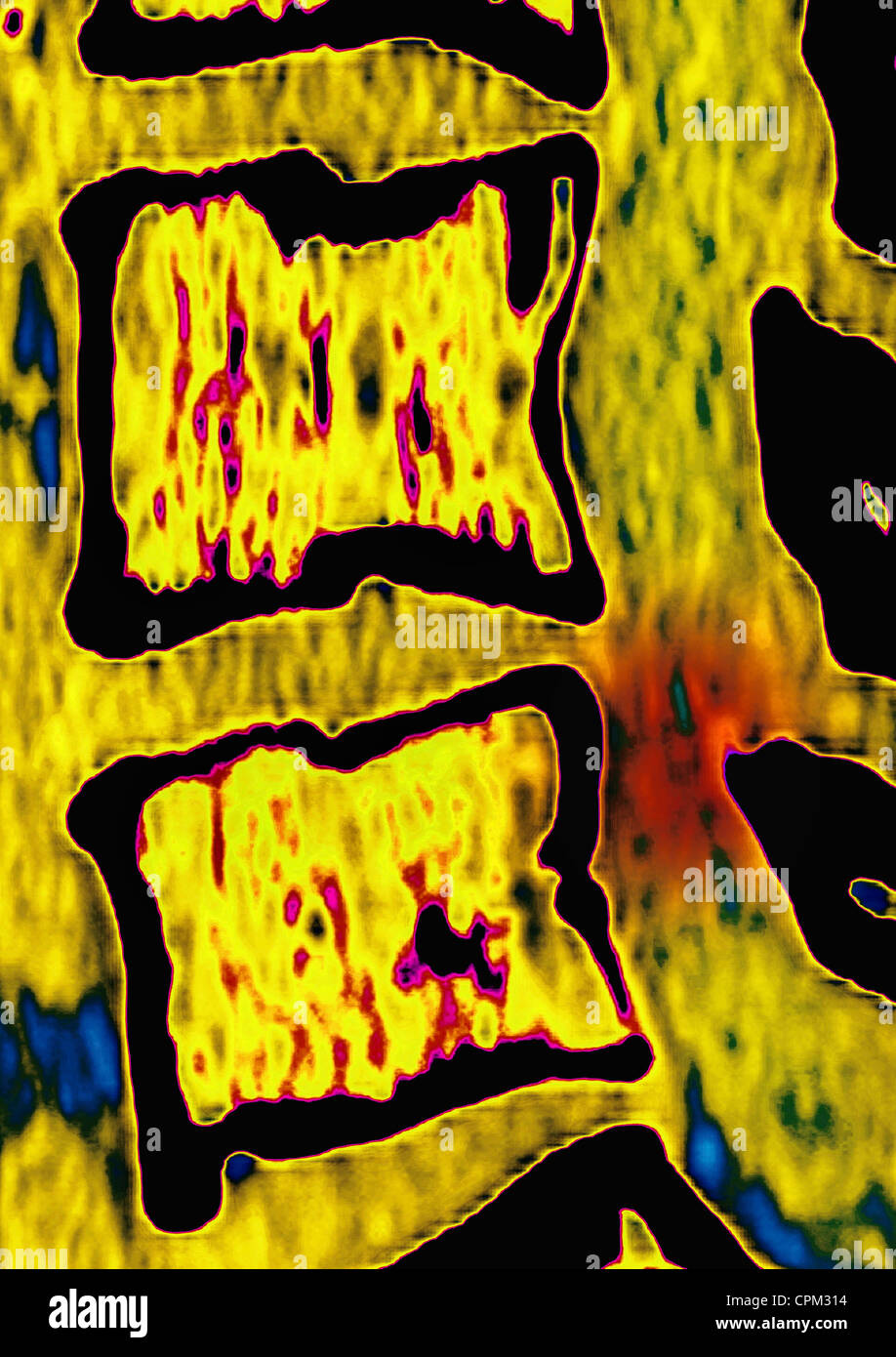 HERNIATED DISK, SCAN Stock Photo - Alamy