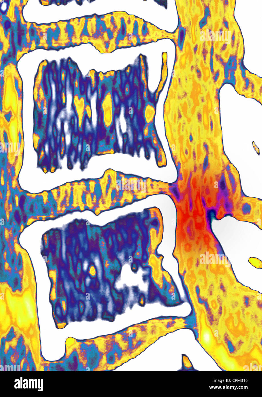 HERNIATED DISK, SCAN Stock Photo - Alamy