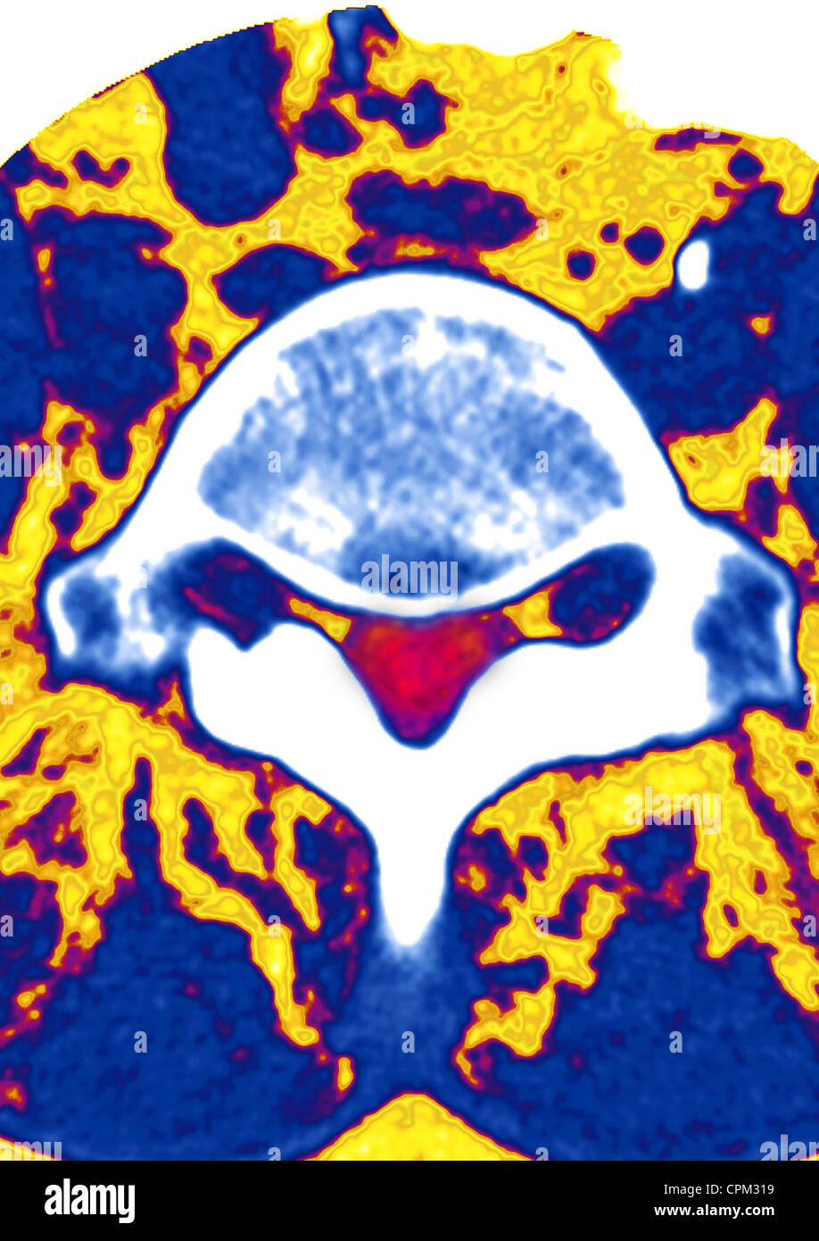 HERNIATED DISK, SCAN Stock Photo - Alamy